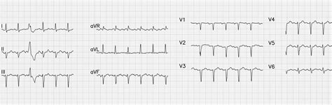 Left Anterior Fascicular Block Significance Edit U Slivermcsilverson