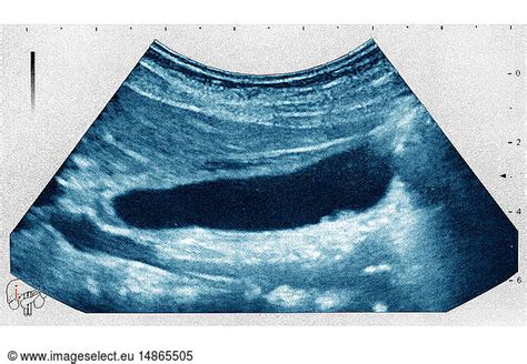 Calculus Cholecystitis Microlithiasis Calculus Cholecystitis