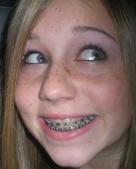 Can You Make Out With Someone Who Has Braces