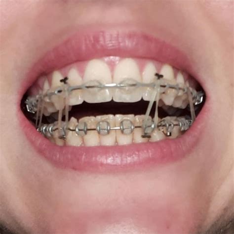 Pin De Singsing En Braces Brackets Dentales Ortodoncia Brackets