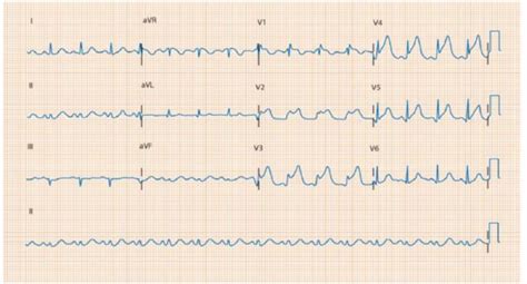 Eletrocardiograma Demonstrando Supradesnivelamento Do Segmento St Em Download Scientific