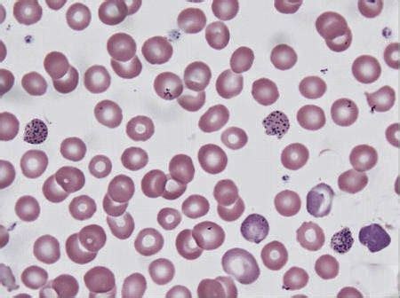 Diffusely Basophilic Erythrocyte