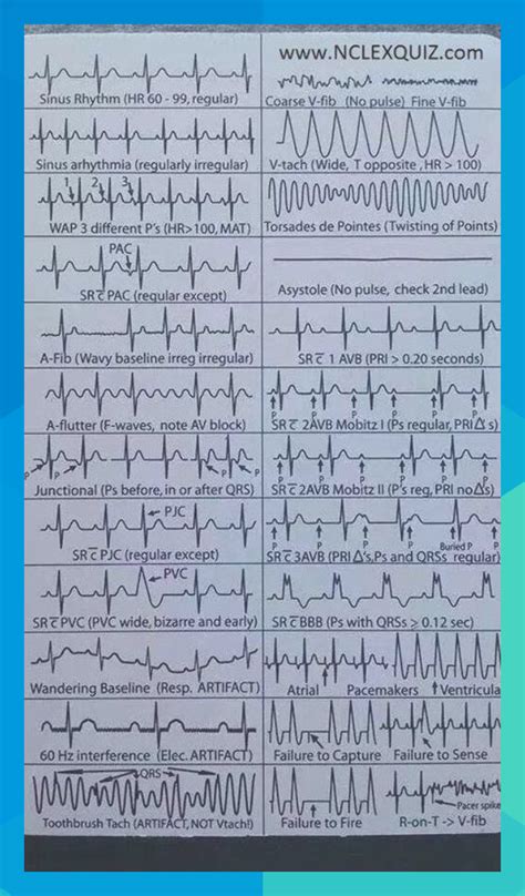 Ekg Heart Rhythms Cheat Sheet