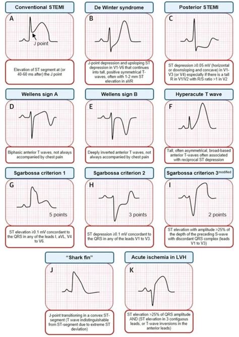 Vertigo Algorithm Rfoamed911