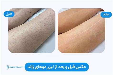 10 مرکز لیزر شیراز نوع دستگاه لیزر و هزینه 1404