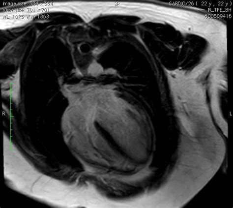 Delayed Myocardial Enhancement Mri In A 4 Chambers View Showing An Download Scientific Diagram