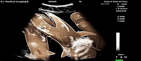 First Ever Ultrasound Image Of A Pregnant Female Shark Video