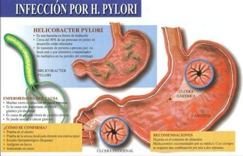 Bacteria Helicobacter Pylori Síntomas Y Tratamiento