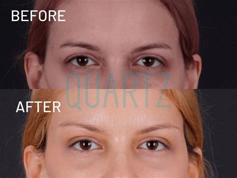 Fox Eye Surgery Price Istanbul Turkey Op Dr Leyla Arvas