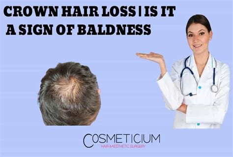 Crown Hair Loss Is It A Sign Of Baldness Cosmeticium