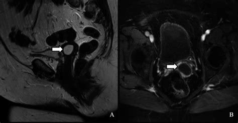 A Radiological Case Series Of Diverse Vaginal Cuff Lesions Pmc