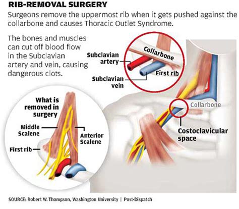 Thoracic Outlet Syndrome Surgery