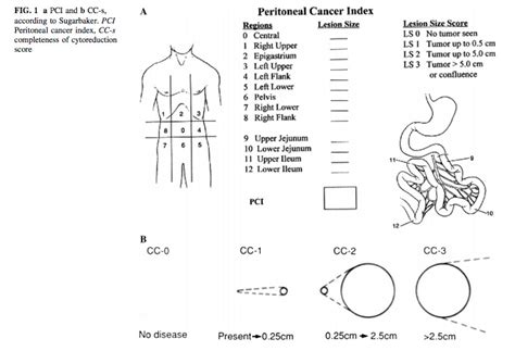Figure Peritoneal Cancer Index Jacquet P Statpearls Ncbi Bookshelf Figure Peritoneal Cancer Index Jacquet P Statpearls Ncbi Bookshelf
