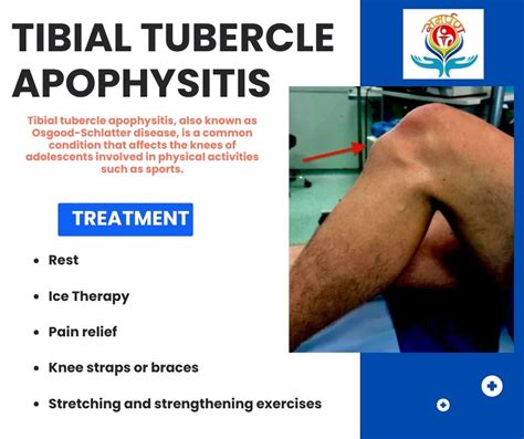 Samarpanphysiotherapyclinic Tibialtubercleapophysitis Osgoodschlatter… Samarpan
