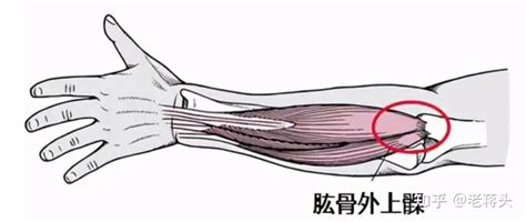不打网球也会患“网球肘”？从成因到治疗全解析——线上居家康复 知乎