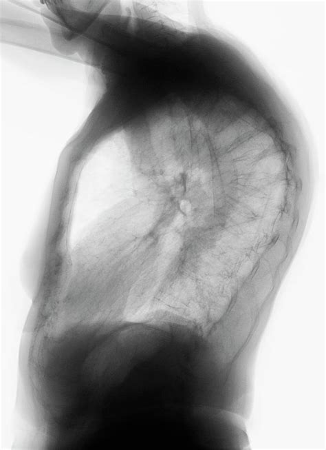 Ct Scan Of Spine Showing Compression Fracture Digital Art By Callista Images Fine Art America