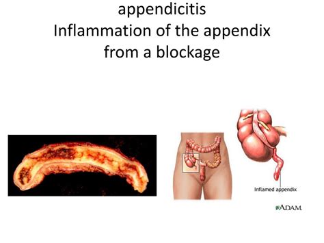PPT Appendicitis Inflammation Of The Appendix From A Blockage PowerPoint Presentation ID