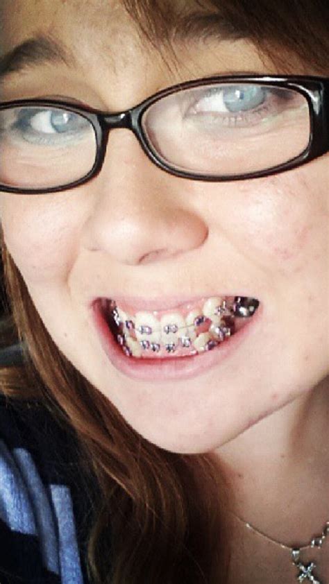 Braces Metalmouth Lover Flickr