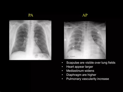 Chest X Ray Interpretation Pdf