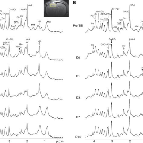 Representative Proton Magnetic Resonance Spectroscopy 1h Mrs Spectra