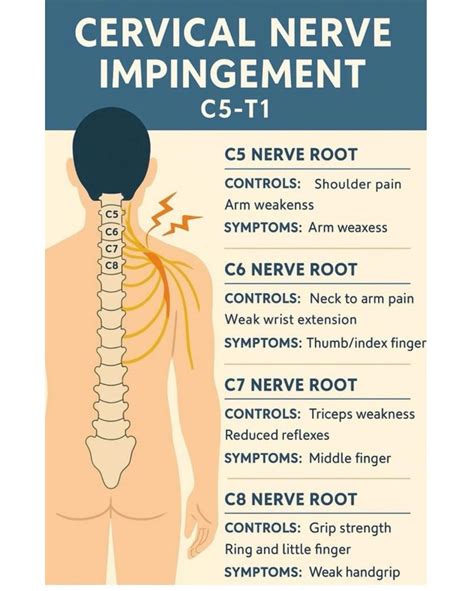 Cervical Nerve Impingement Causes Symptoms Diagnosis And Treatment