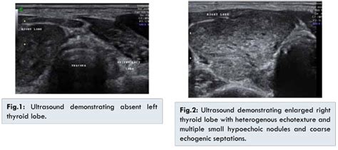 Thyroid Hemiagenesis A Rare Finding