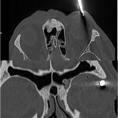 Orbit X Ray After Extraction Download Scientific Diagram