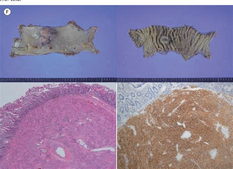 Figure 1 From Identifying Small Bowel Gastrointestinal Stromal Tumor As