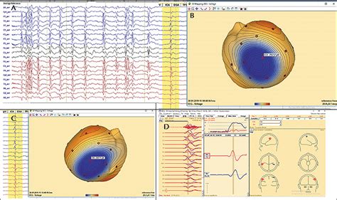 John Libbey Eurotext Epileptic Disorders Classification Of Electrical Status Epilepticus In