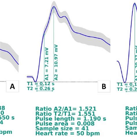 Intracranial Pressure Waveform Monitoring With An Improvement In The Download Scientific