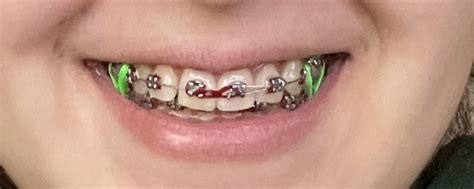 Finally Done R Braces