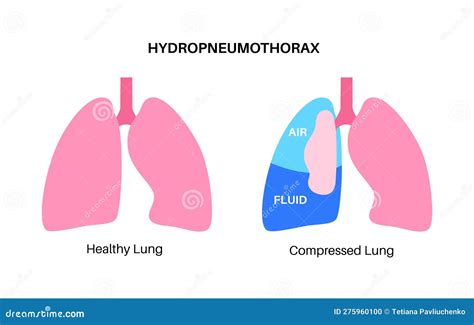 Hydropneumothorax Medical Poster Vector Illustration Cartoondealer