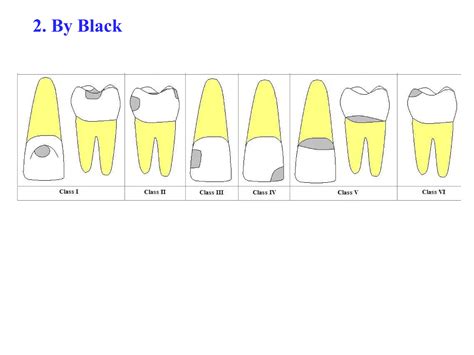 Etiology And Pathogenesis Of Dental Caries Classification Of Caries Clinical Features Of