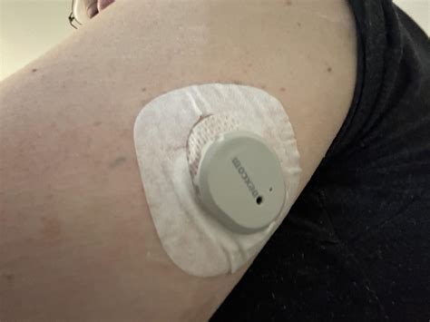 Already Falling Off R Dexcom