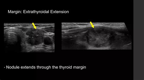 Thyroid Imaging Reporting And Data System Pptx