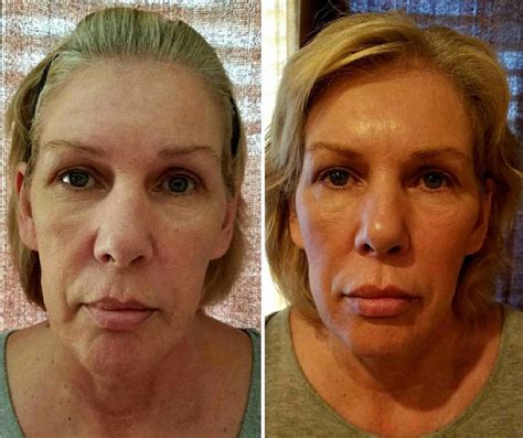 Liquid Facelift In Phoenix Before And After Facelift Info Prices Photos Reviews Q A