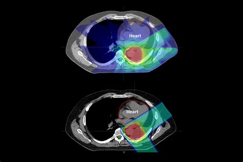 Proton Therapy As Effective As Standard Radiation With Fewer Side Effects Siteman Cancer Center