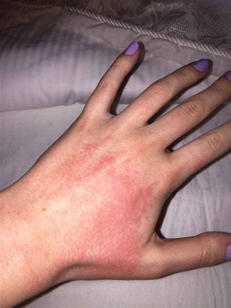 Help Rash On Hands From Accutane Prescription Acne Medications