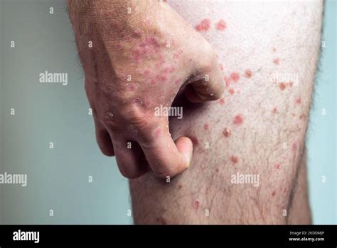 Unrecognizable Man Suffering From Psoriasis Scratching Thick Scaly