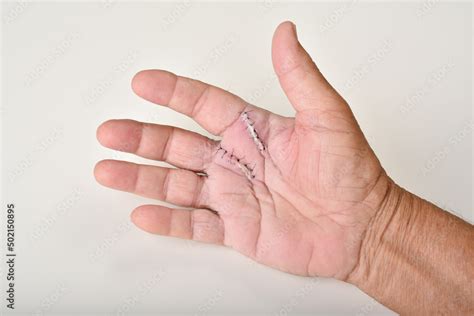 Best Trigger Finger Release Surgery In Florida