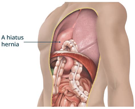 Hiatal Hernia Anatomy