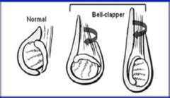Disorders Of The Scrotum And Testis Quizlet