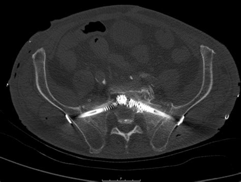 Pelvic Fracture Fixation Fixation Of Sacroiliac Joint Diastasis Using Brainlab Navigation