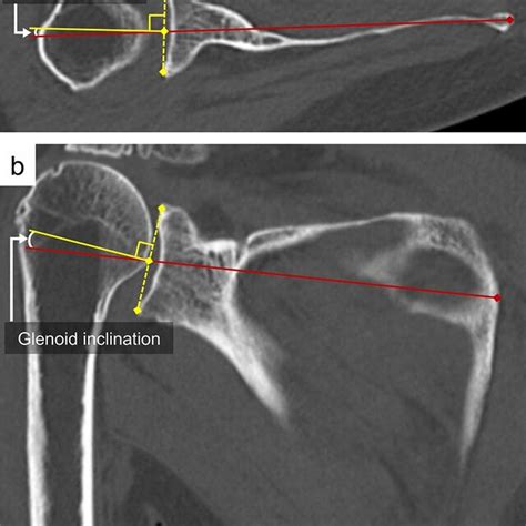Pre Operative Measurement Of Glenoid Version And Inclination A Download Scientific Diagram