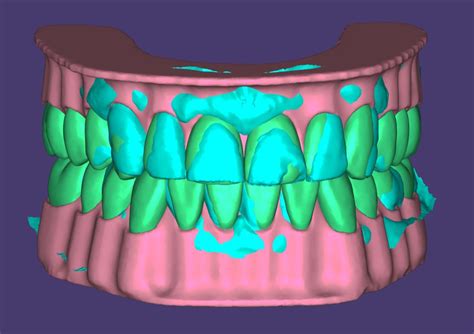 Donia Hazem On Linkedin Digitaldentist Everythingdental Cadcam