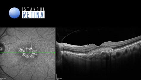 64 Acquired Vitelliform Lesion In The Setting Of Age Related Macular
