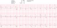 T Wave INVERSION Mnemonic ECG Cases Emergency Medicine Cases