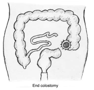 Laparoscopic Hartmann Procedure Technique Laparoscopic Approach To