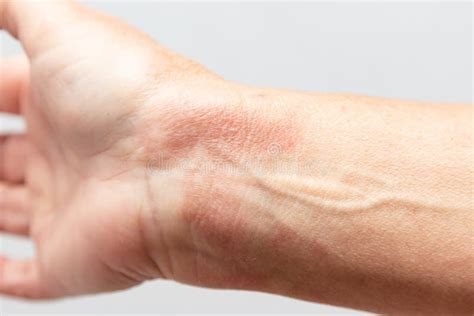 Thermal Burn Of The Skin On The Arm Stock Photo Image Of Hand Kitchen 241379014