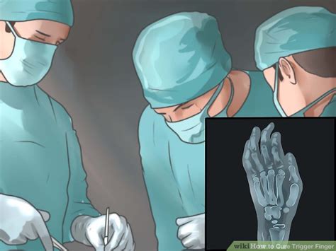 How To Cure Trigger Finger 10 Steps With Pictures Wikihow